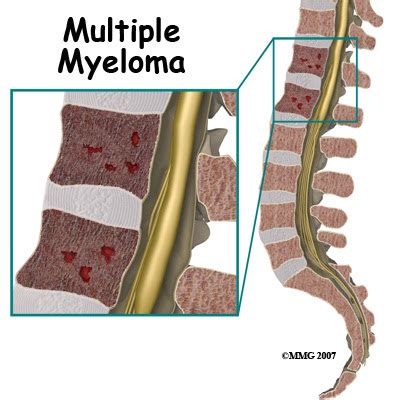 Health Cancer Diseases Sexual Diseases Pregnancy Multiple Myeloma