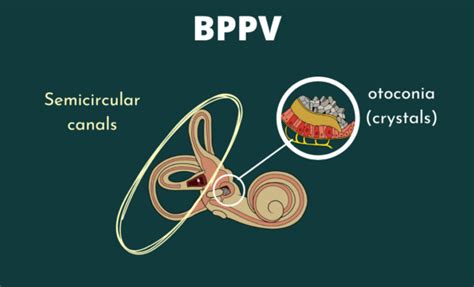 3 Helpful Bppv Treatment Exercises To Do At Home And How To Do Them