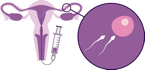 Intrauterine Insemination Iui In Tijuana Mexico