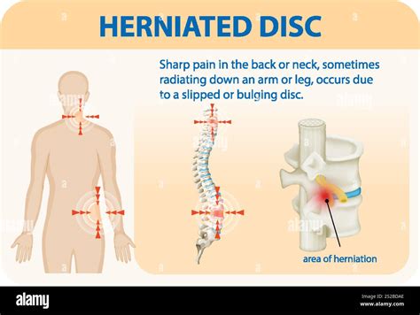 Illustration Of Herniated Disc And Associated Pain Areas Stock Vector