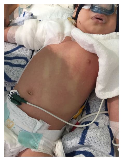 Deteriorated Central Capillary Refill With Palm Mark On The Torso Download Scientific Diagram