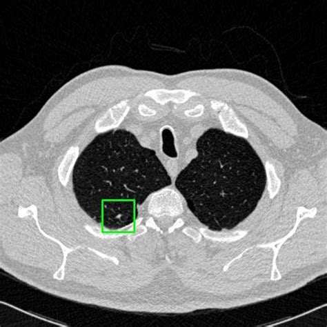 Extra Od Lung Nodules Object Detection Dataset By University Of Technology Sydney
