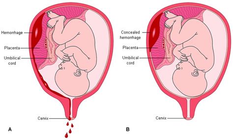 Partial Placental Abruption