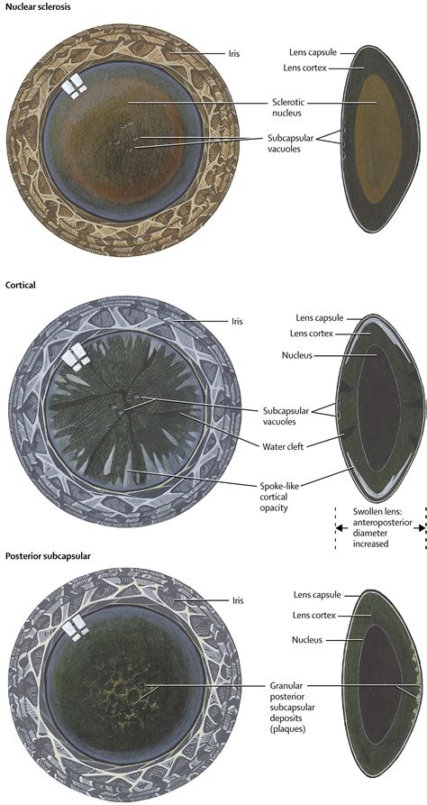 Age Related Cataract The Lancet