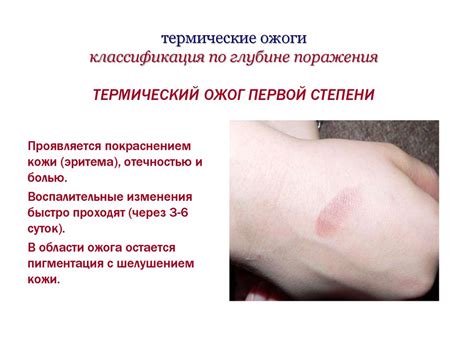 Термические поражения. Ожоги, холодовая травма, электротравма - online ...