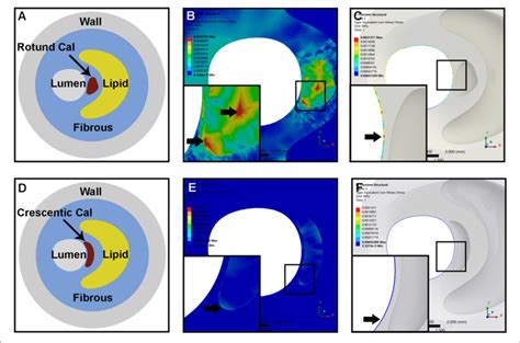 the idealized models of an atheromatous plaque with rotund