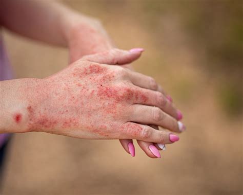 Lupus Symptoms Treatment Self Care Optimists Wellness India