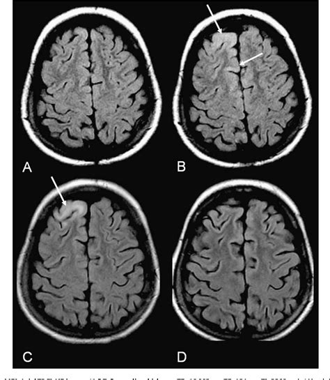 Figure 1 From Anti Nmda Receptor Encephalitis Presenting With Imaging