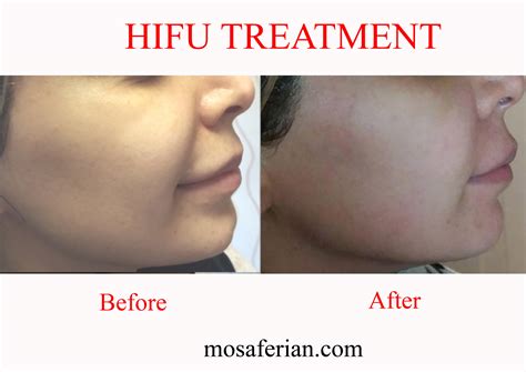 Hifu Treatment Lifts And Tightens Skin For A Non Surgical Face Lift