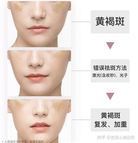 为什么很多人的黄褐斑无法祛除反而加重 知乎