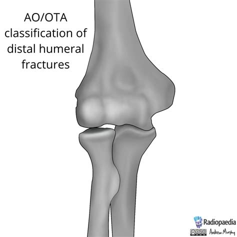 Radiopaedia Case Aoota Classification Of Distal Humeral Fractures Id
