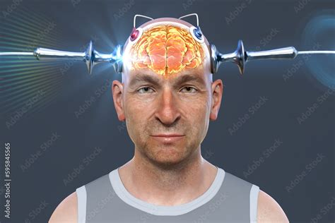Electroconvulsive Therapy Ect A Treatment Involving The Use Of