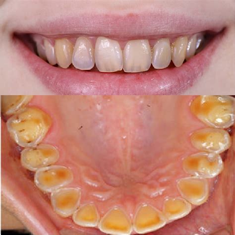 Erosion Teeth
