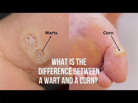 What Does A Wart Look Like Between Toes Infoupdate Org