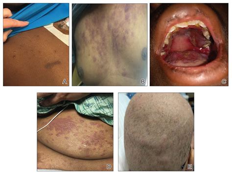 Clinical Characterization Of Leukemia Cutis Presentation Mdedge
