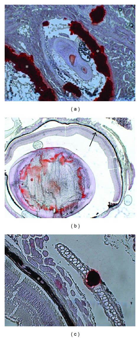Histopathology Of Pseudoxanthoma Elasticum And Related Disorders Histological Hallmarks And