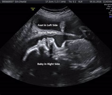 Bicornuate Uterus Ultrasound Spontaneous Twin Pregnancy In Uterus