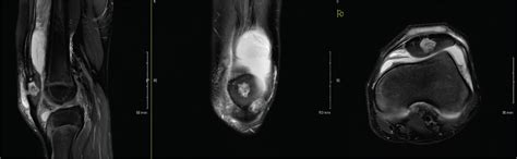 Patella Osteomyelitis Masquerading As Prepatellar Bursitis Journal Of