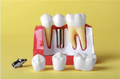 Dental Implant Vs Crown Which Is Right For You