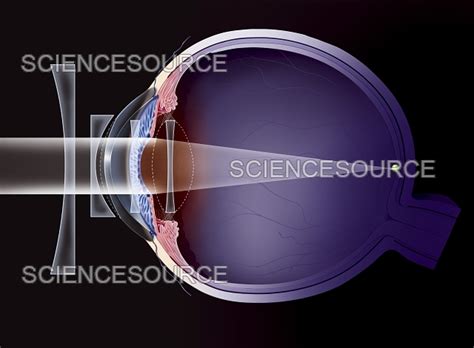 Myopia Correction Stock Image Science Source Images