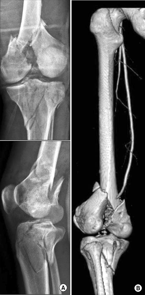 Distal Femur
