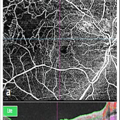 Intra Retinal Microvascular Abnormalities A Magnified 12mm×12mm En Download Scientific
