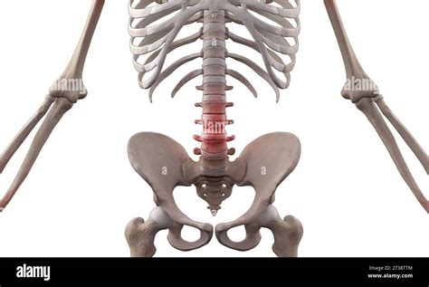 Lumbar Spine Compression Fracture Radiologypics Com Vrogue Co