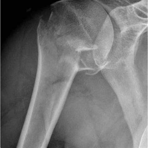 Proximal Humerus Fracture Preoperative Download Scientific Diagram