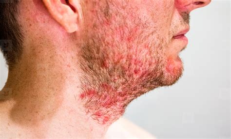 Psoriasis Beard