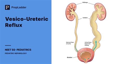 Vesico Ureteric Reflux Pathophysiology Clinical Features