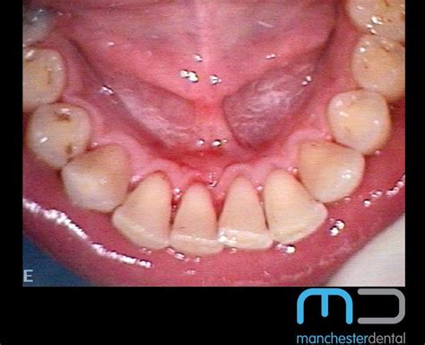 Stain Removal - Manchester Dental