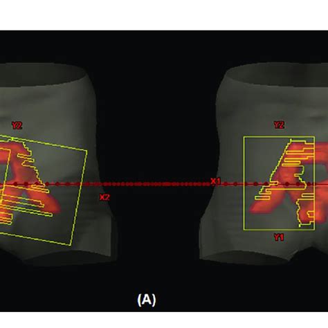 A A Suboptimal Multi Leaf Collimator Mlc Segment In Volumetric Download Scientific