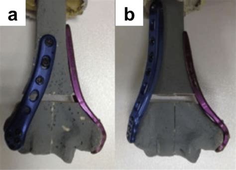 Photographs Of The A Orthogonal B Parallel Plating Samples In Posterior Download Scientific