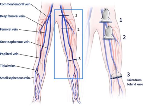 Point‐of‐care Ultrasound For Deep Venous Thrombosis Of The Lower Limb