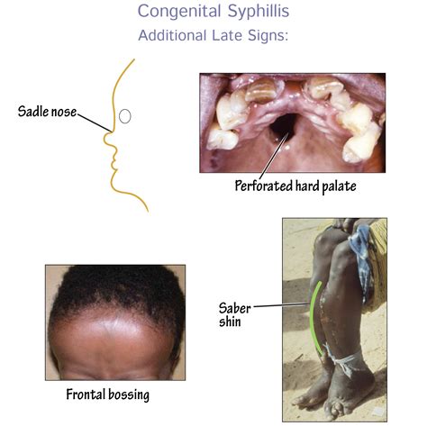 Immunology Microbiology Glossary Congenital Syphilis Ditki Medical