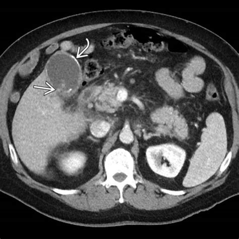 Porcelain Gallbladder Clinical Gateclinical Gate