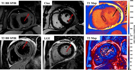 Parametric Mapping Cmr For The Measurement Of Inflammatory Reactions Of