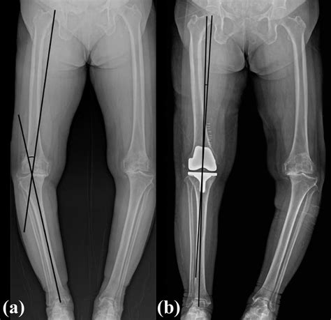 Postoperative Radiologic Outcome Comparison Between Conventional And Computer Assisted