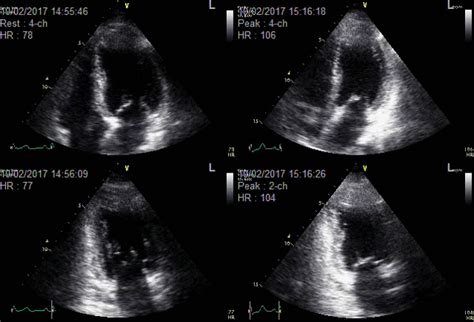 Abnormal Echocardiogram