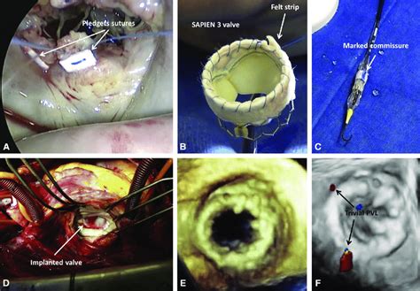Procedural Steps A Exposure Of The Mitral Valve Through A Left Download Scientific Diagram