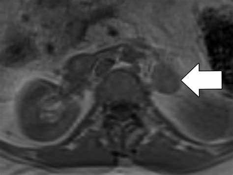 Utility Of Mri To Differentiate Clear Cell Renal Cell Carcinoma Adrenal Metastases From Adrenal