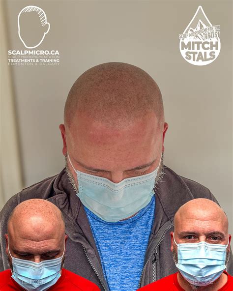 Scalp Micropigmentation Treatments Smp Edmonton Scalp Micropigmentation Treatments Smp Edmonton