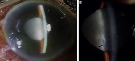 Phacomorphic Glaucoma Ophthalmology Glaucoma
