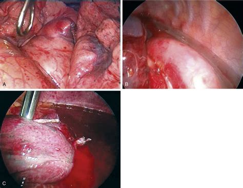 Left Upper Lobe Apical Trisegmentectomy—video 16 1 Clinical Gate