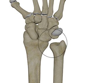 Distal Radioulnar Joint Dislocation Wikism Sports Medicine Wiki