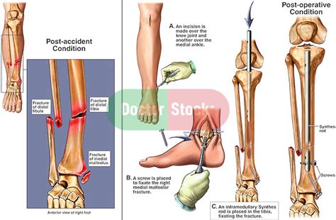 Orif Tib Fib Fracture Hardware Leobj