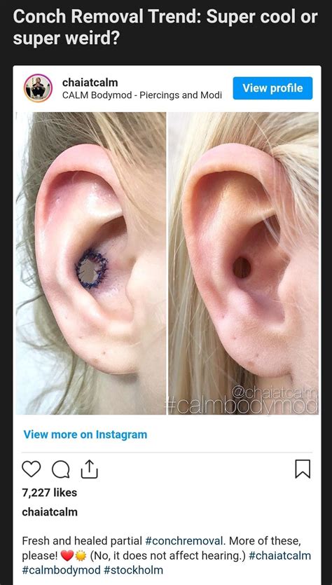 Conch Removal Body Modification Pretty Ear Piercings Body Mods Piercings Unique