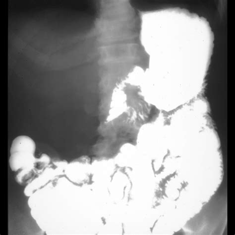 Pediatric Radiation Induced Enteritis Pediatric Radiology Reference