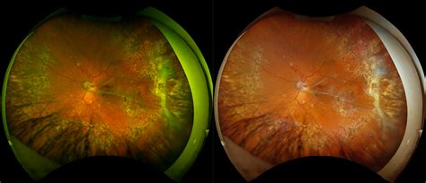 California Diabetic Retinopathy With Vitreous Traction Rg Rgb