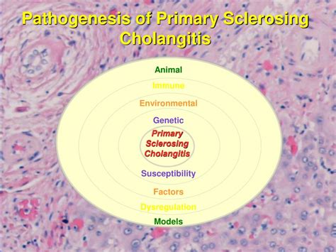 PPT CLUSTERING OF PRIMARY SCLEROSING CHOLANGITIS NEAR TOXIC WASTE SITES PowerPoint